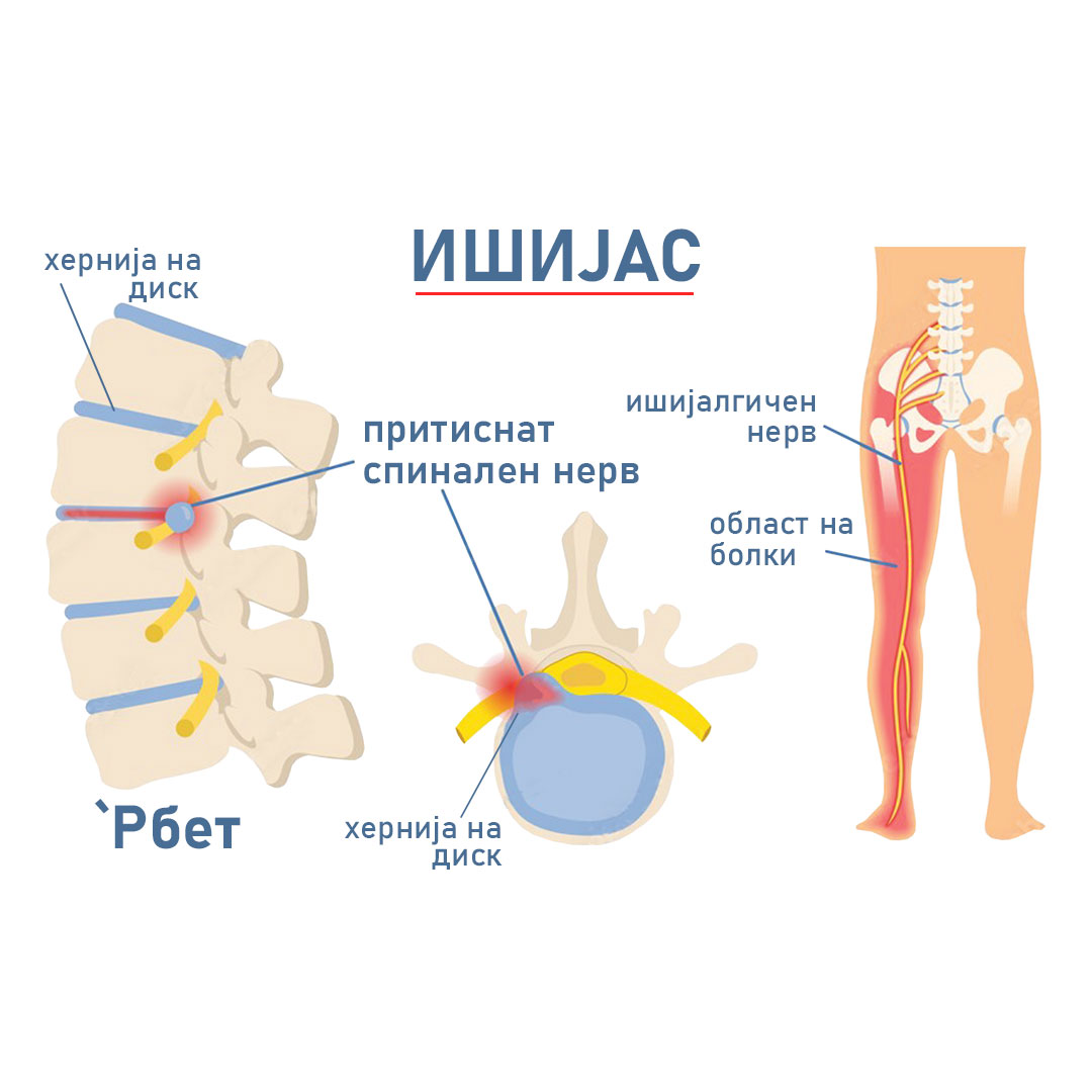 Ишијас - интезивна болка во половината - Slavej